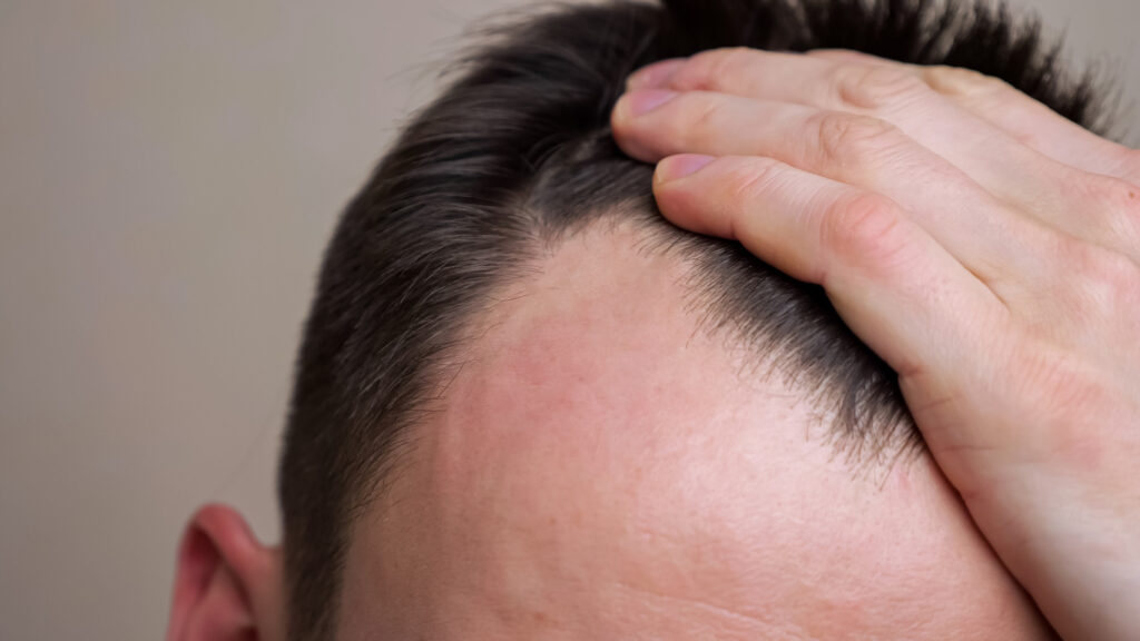 8 Signs of Going Bald - Hair Transplant Center - New York City